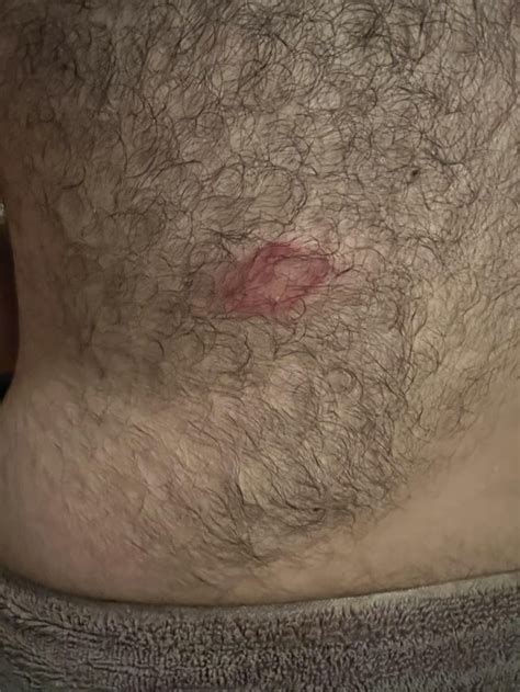 Potential Lyme Bite Rash Rlyme