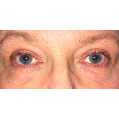 Patient 272 Ptosis Repair Before And After Photos Chicago IL