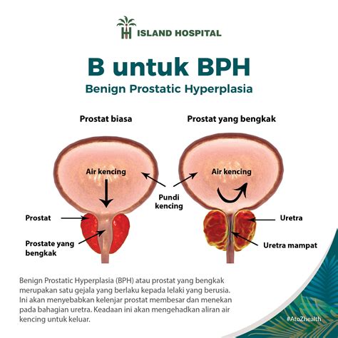 National Cancer Society Of Malaysia Penang Branch Benign Prostatic
