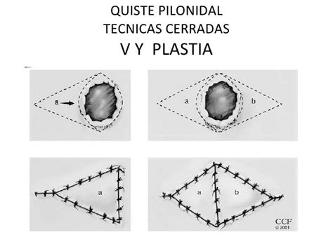 Quiste Pilonidal