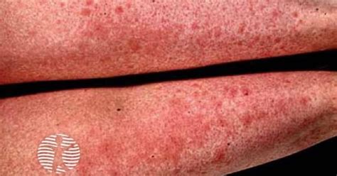 Polymorphous Light Eruption Image