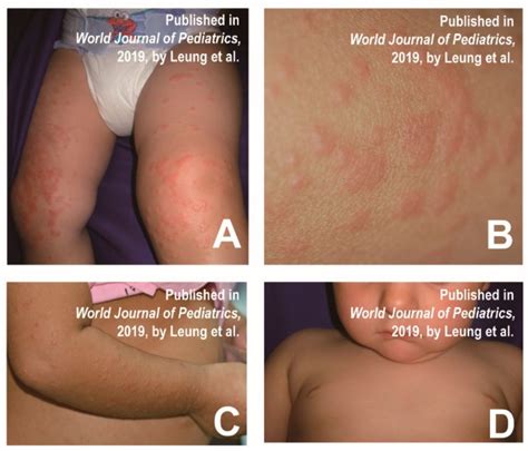 Exploring Coxsackievirus Infections From Diagnosis To Treatment Ask