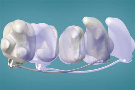 Ortho Carriere Motion Class Ii Appliance