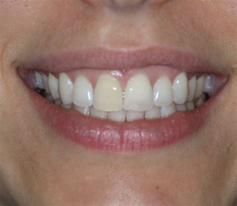 Veneers Advance Dental Pc Dentist Birmingham Al