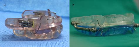 Mandibular Advancement Devices A Somnodent And B Telescopic Herbst