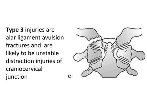 Cervical Spine Fractures And Injuries Classification Pptx Death