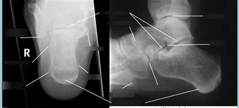 Routine Radiographs Of The Calcaneous Bone Anatomy Label Diagram Quizlet