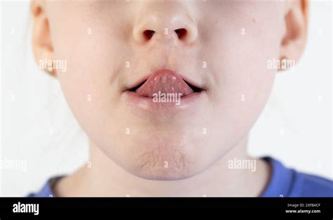 The Girl Shows Her Tongue Out Of Her Mouth Concept Of Pathologies Of The Frenulum Of The Tongue