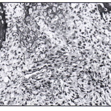The Sarcomatous Component Is Gfap Negative Except For Isolated Cells