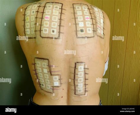 Skin Patch Test