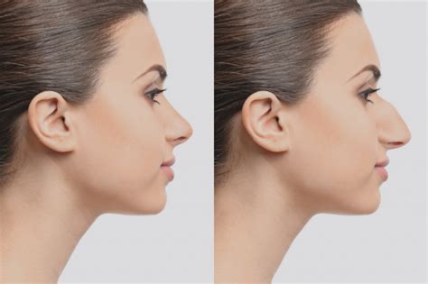 Non Invasive Nose Job Transform Your Look In Dubai