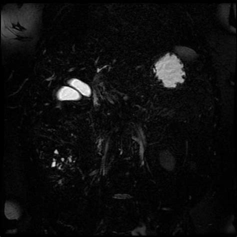 Gallbladder Duplication Pacs