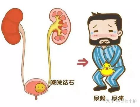 有一种痛，叫泌尿系统结石痛！ 知乎