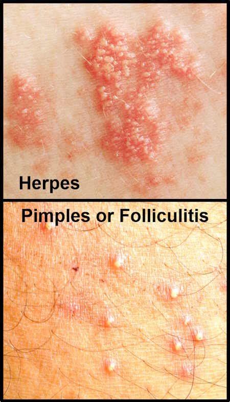 Herpes Vs Pimple