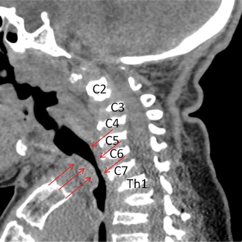Ct Of Tracheal Obstruction In A 17 Year Old Patient With Morquio A Ct