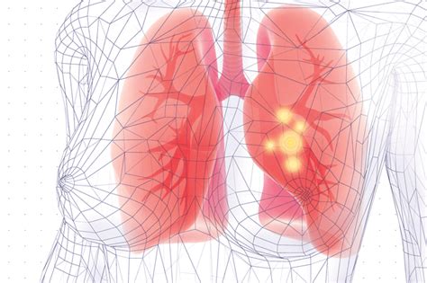 Pneumonia O Que é Sintomas Causas E Tratamentos Icardio