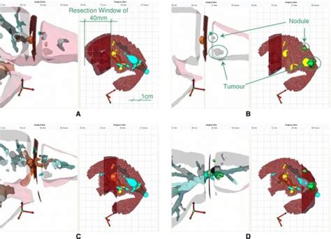 Internal View Of The Resection Map Showing Some Of Its Visualization