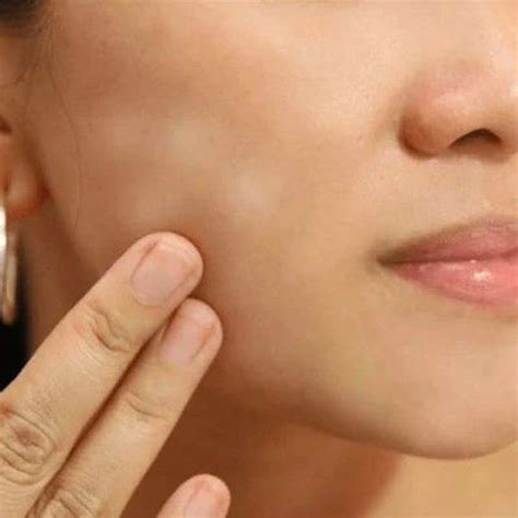 How To Get Rid Of White Spots On Face At Home