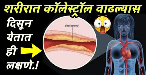 शरीरातील कोलेस्टेरॉल पातळी वाढल्याची लक्षणे”जाणून घ्या” वेळीच ओळखला