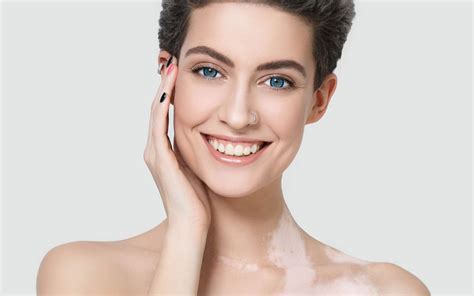Saiba O Que é E Como Tratar O Vitiligo Applisi Histórico Médico Online