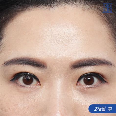 눈밑지방재배치 2개월 후 미드라인성형외과
