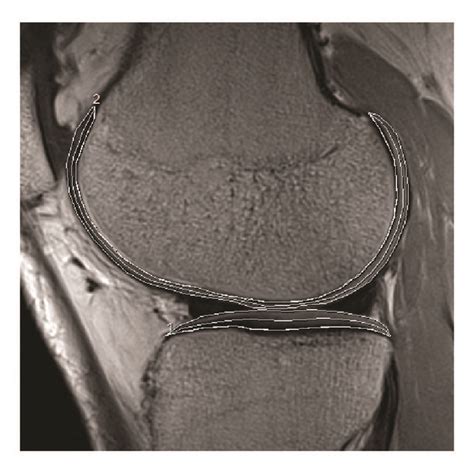 1 And 2 Showed The Outlines Of The Lateral Tibia LT And Lateral Download Scientific