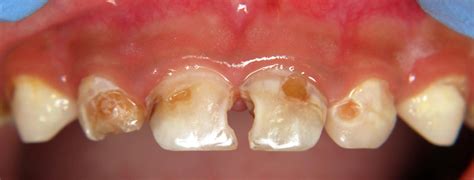 Syndrome Du Biberon Dr Rose Marie SANCHEZ Chirurgien Dentiste