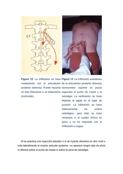 Figura La Infiltraci