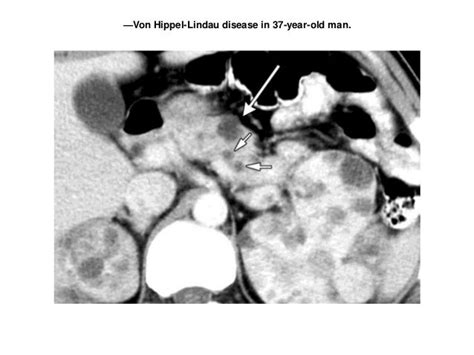 Cystic Tumors Of The Pancreas