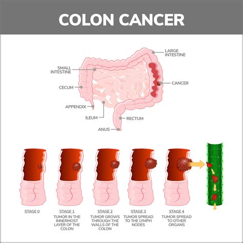 What Are Polyps Gastroenterology Of Greater Orlando