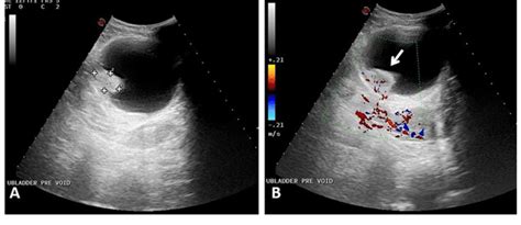 Ultrasound Of Urinary Bladder Grey Scale A And Color Doppler B