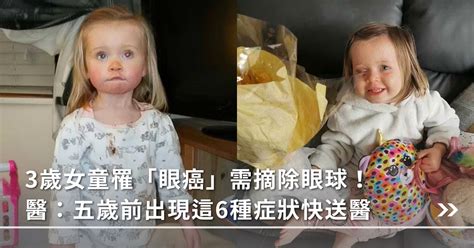3歲女童罹「眼癌」需摘除眼球！醫：五歲前出現這6種症狀快送醫 媽媽經｜專屬於媽媽的網站