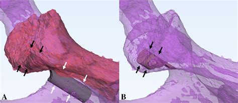 Figure 1 From Optimal Insertion Site Of Glenoid Baseplate In Reverse Total Shoulder Arthroplasty