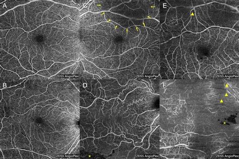 Deep Learning For Quality Assessment Of Optical Coherence Tomography