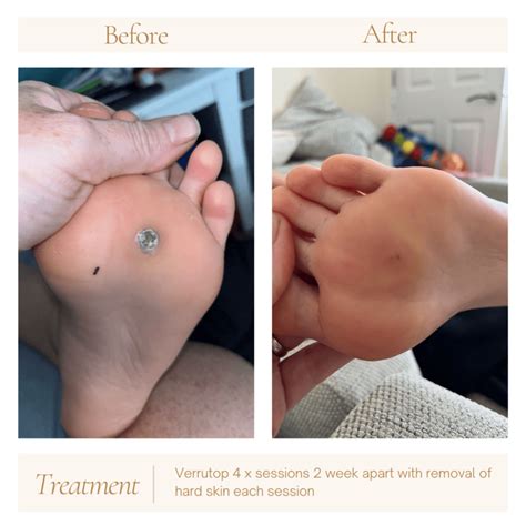 Verrutop Case Studies Real Results In Verruca Treatment