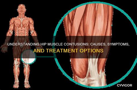 Understanding Hip Muscle Contusions Causes Symptoms And Treatment