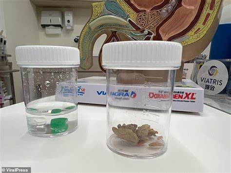 Shocked Doctor Discovers 30 Year Build Up Of Smegma Under The Foreskin