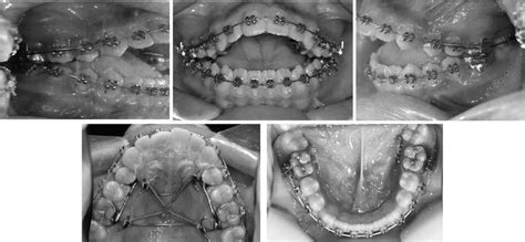 Continuous Arch Wires Were Placed On Both Arches And Intrusive Force