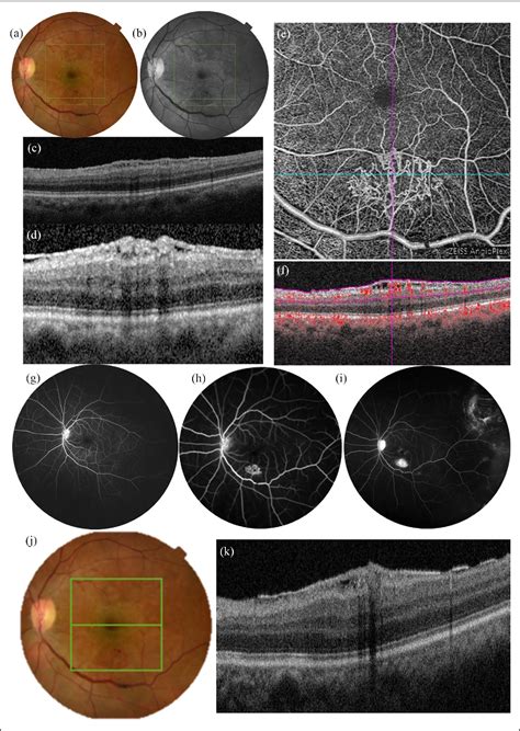 Figure 1 From Multimodal Imaging Of A Vascularized Idiopathic