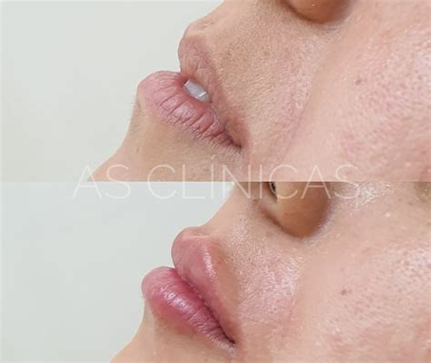 Preenchimento Labial Caso AS Clínicas