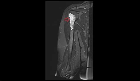 Enchondroma Mri Radiology Article On Enchondroma Mri