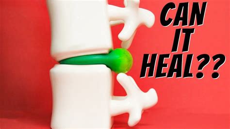 Can My Herniated Bulging Disc Or Sciatica Heal How Long Youtube Bulging Disc Herniated