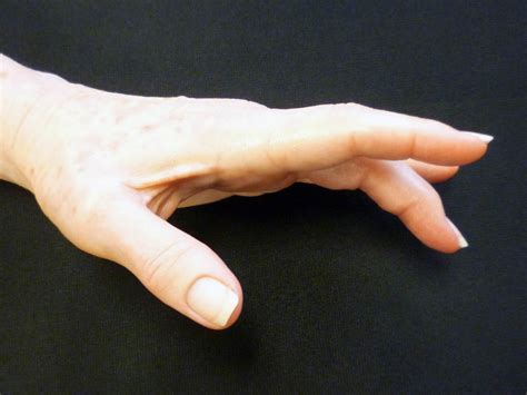 Treating The Stiff PIP Joint Why Did You Do It That Way