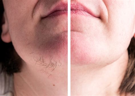 Laser Hair Removal Ottawa For Smooth Skin You Derma