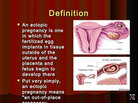 Ectopic Pregnancy By Dr Shashwat Jani