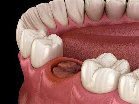 How To Treat And Avoid Dry Sockets After Wisdom Tooth Removal