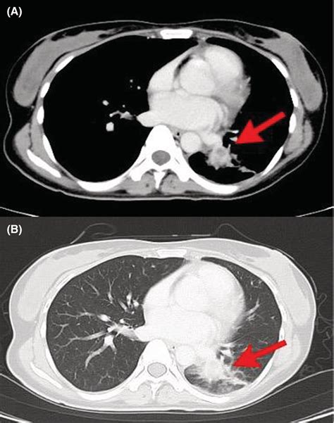 Computed Tomography Ct Of Septic Pulmonary Embolism A A Contrast