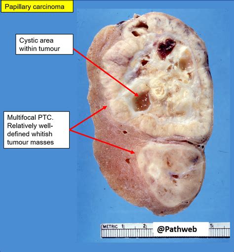 Papillary Carcinoma