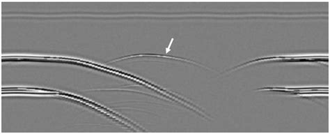 Case 2 Civa Simulation B Scan For Defect Of 2 Mm In Size At The Download Scientific Diagram