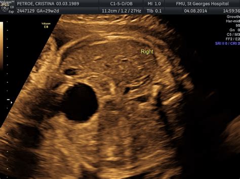 A Case Of Zinners Syndrome Seminal Vesicle Cyst With Ipsilateral